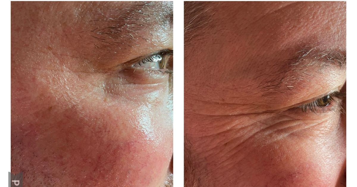 Infuzion System – Needle-Free skin rejuvenation before & after